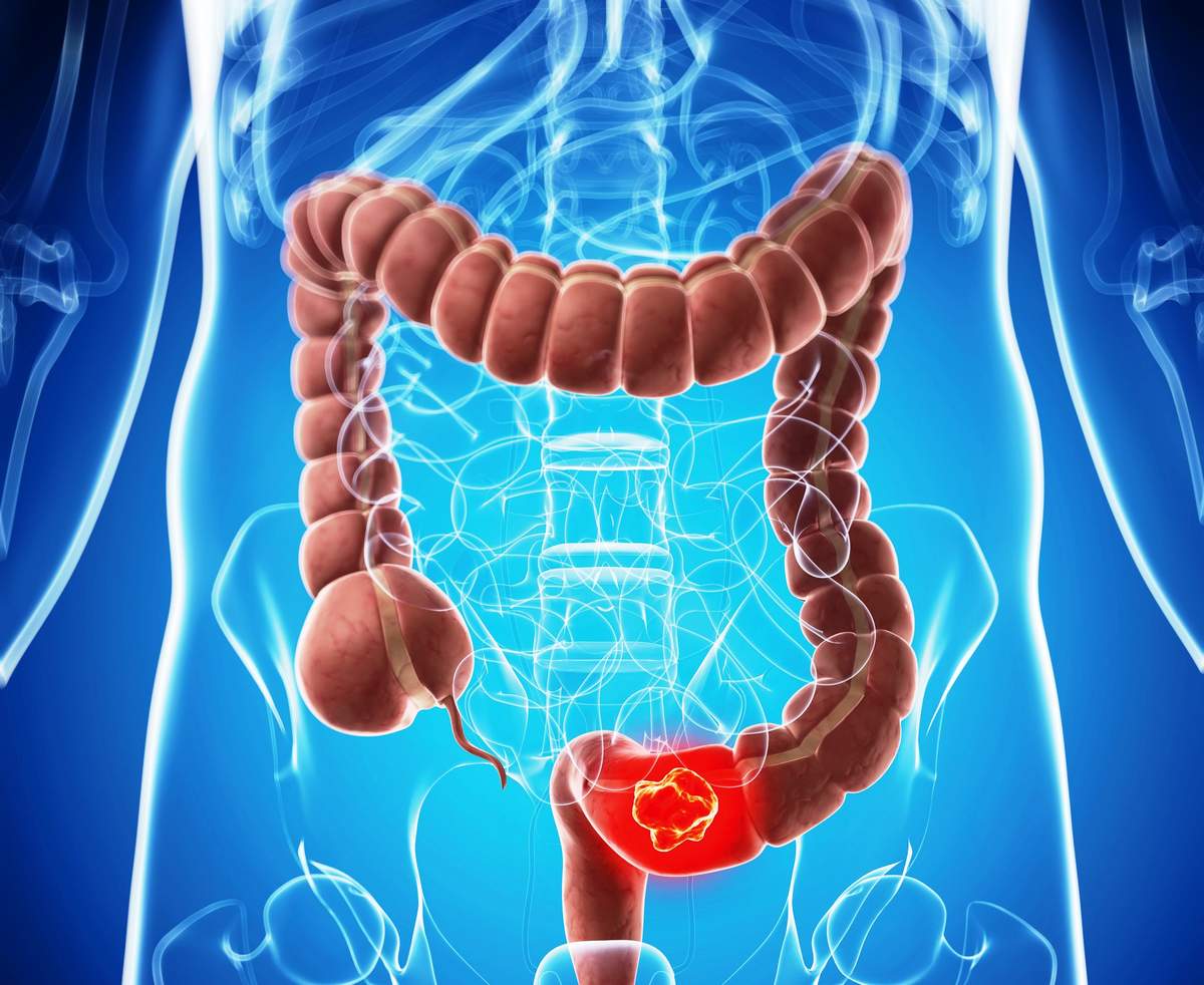 Darm-OP mit besonderer Art der Schlüssellochchirurgie (SILS)